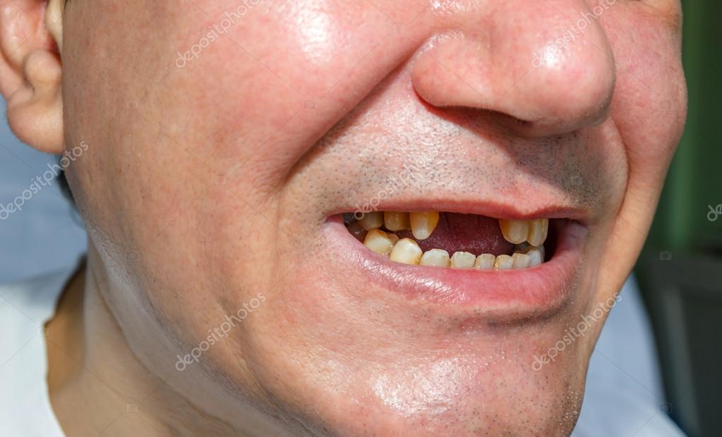 Hombre sin dientes pelados — Foto de stock #111912794 © irinaorel