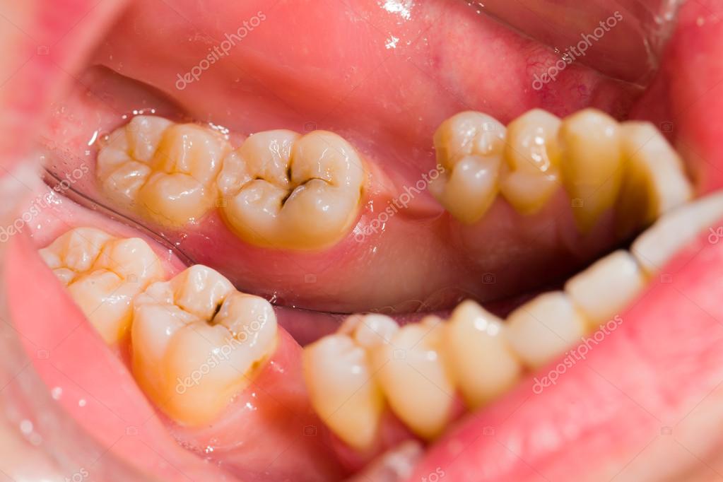 Cavity between healthy teeth — Stock Photo © Lighthunter #57079205