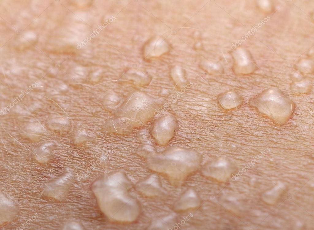 Piel con ampollas .: fotografía de stock © grib_nick #71191871 ...