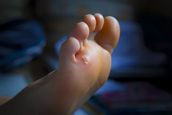 Calluses Stock Photos, Royalty Free Calluses Images | Depositphotos