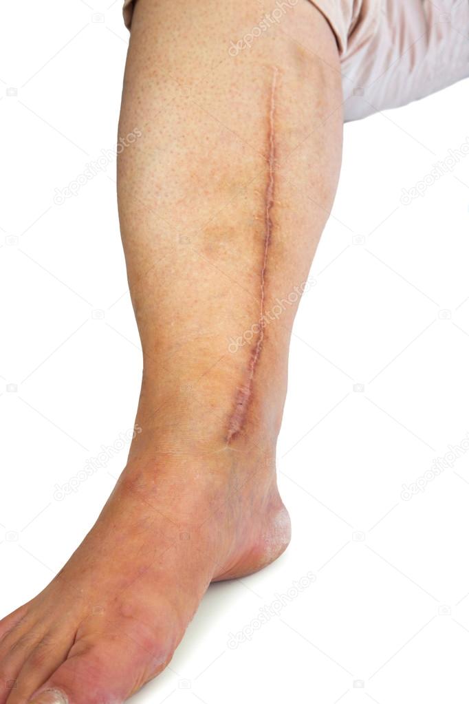 Human leg with postoperative scar of cardiac surgery ⬇ Stock Photo ...