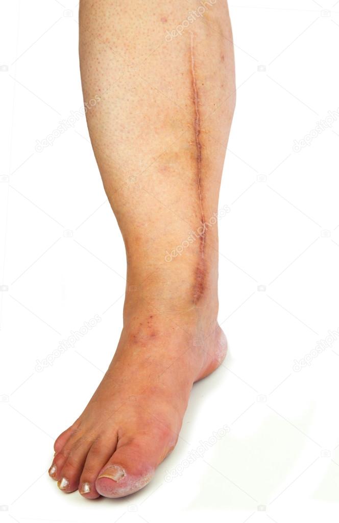 Human leg with postoperative scar of cardiac surgery — Stock Photo ...