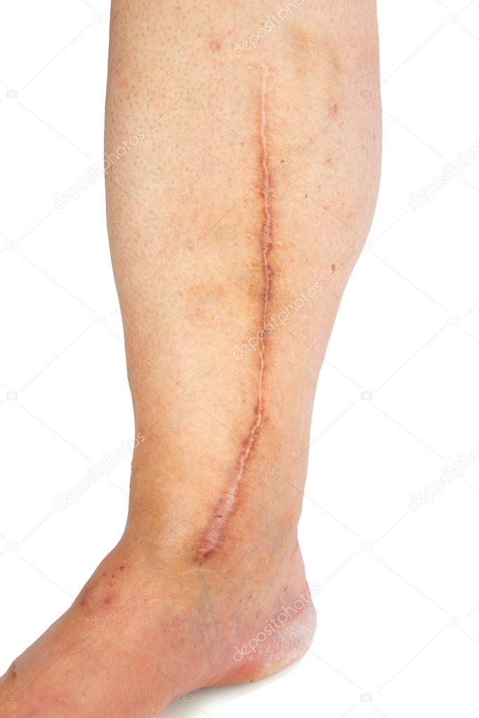 Human leg with postoperative scar of cardiac surgery — Stock Photo ...