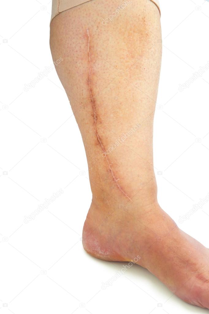 Human leg with postoperative scar of cardiac surgery ⬇ Stock Photo ...