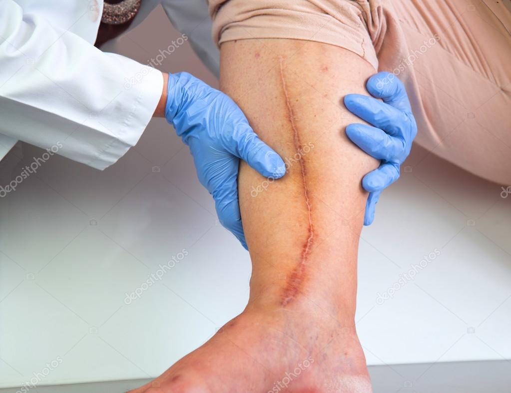 Human leg with postoperative scar of cardiac surgery — Stock Photo ...
