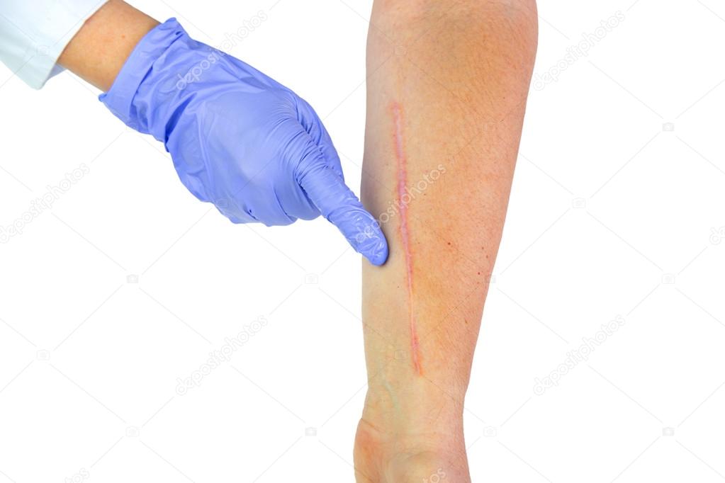 Human arm with postoperative scar of cardiac surgery Stock Photo by ...