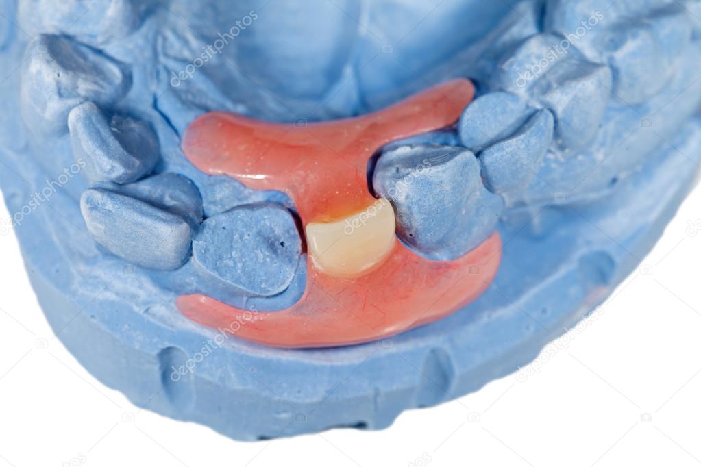 Removable incisor prosthesis Stock Photo by ©obencem 53549461