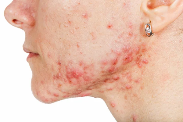 Pápulas fotos de stock, imágenes de Pápulas sin royalties | Depositphotos