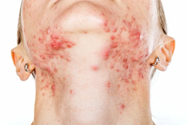 Imágenes de Papula libres de derechos | Depositphotos