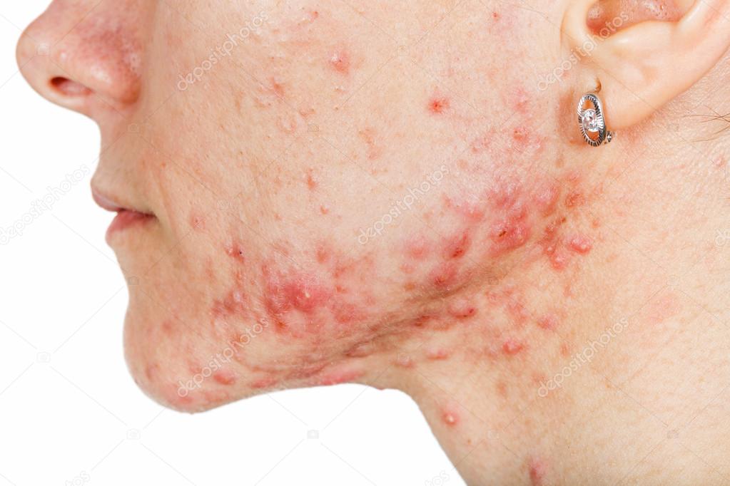 Chica joven con problemas de piel — Foto de stock #99241862 © obencem