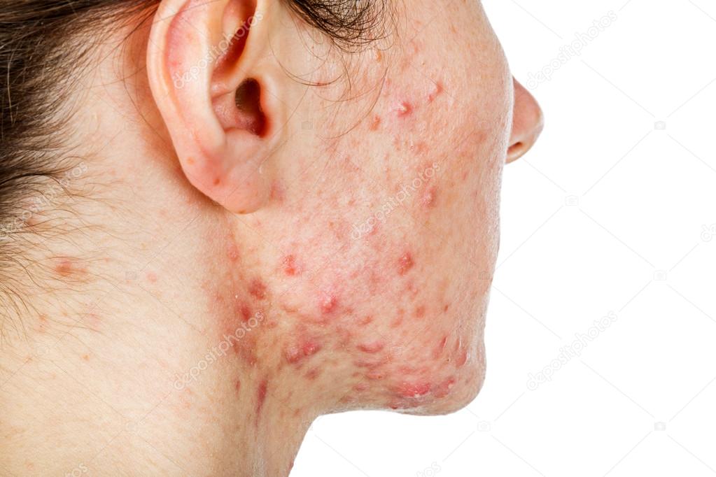 Nodulocystic Acne