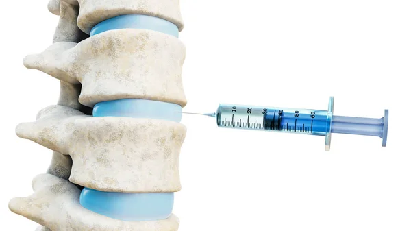Spinal injection Stock Photos, Royalty Free Spinal injection Images ...