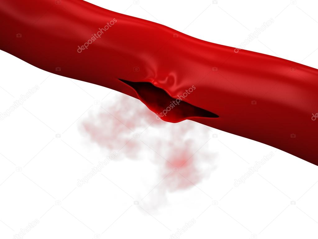 Ophthalmic Artery Rupture Bleeding Eye