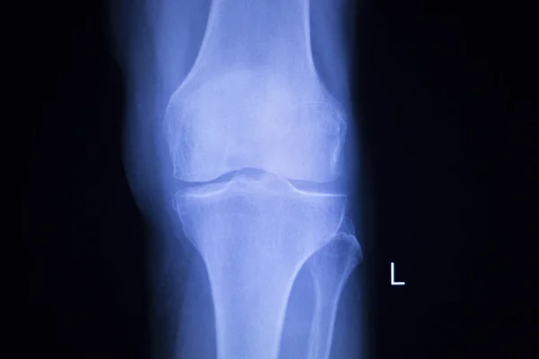 X-ray orthopedics scan of painful knee meniscus leg injury — Stock ...