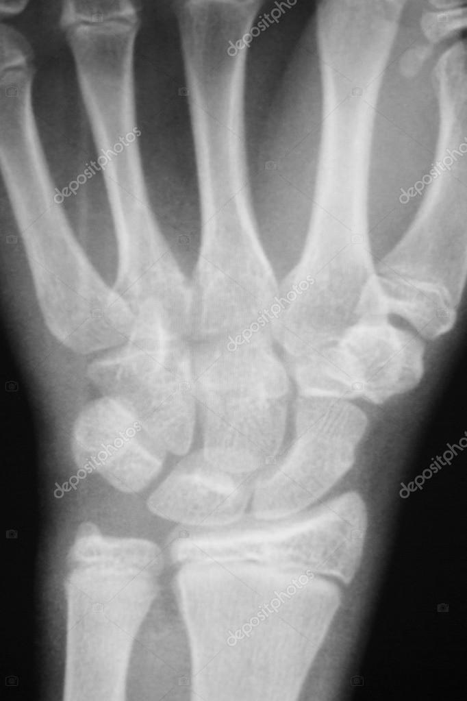 Prsty ruky palec skenování RTG zápěstí — Stock Fotografie © edwardolive ...