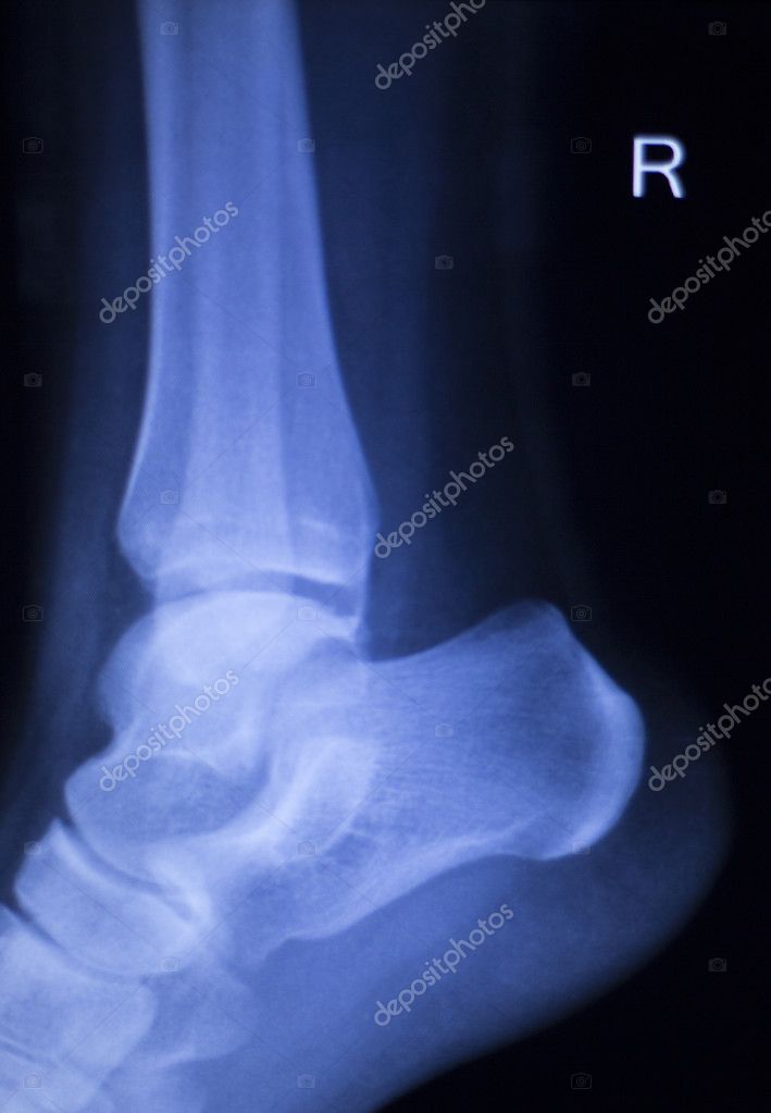 Lesión en el tobillo del pie escaneo de rayos X 2024