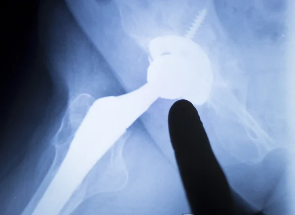 X-ray scan image of hip joint replacement orthopedic implant Stock ...
