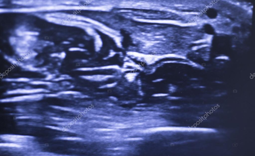 Ultrasound ecograph EPI ecography — Stock Photo © edwardolive #113263548