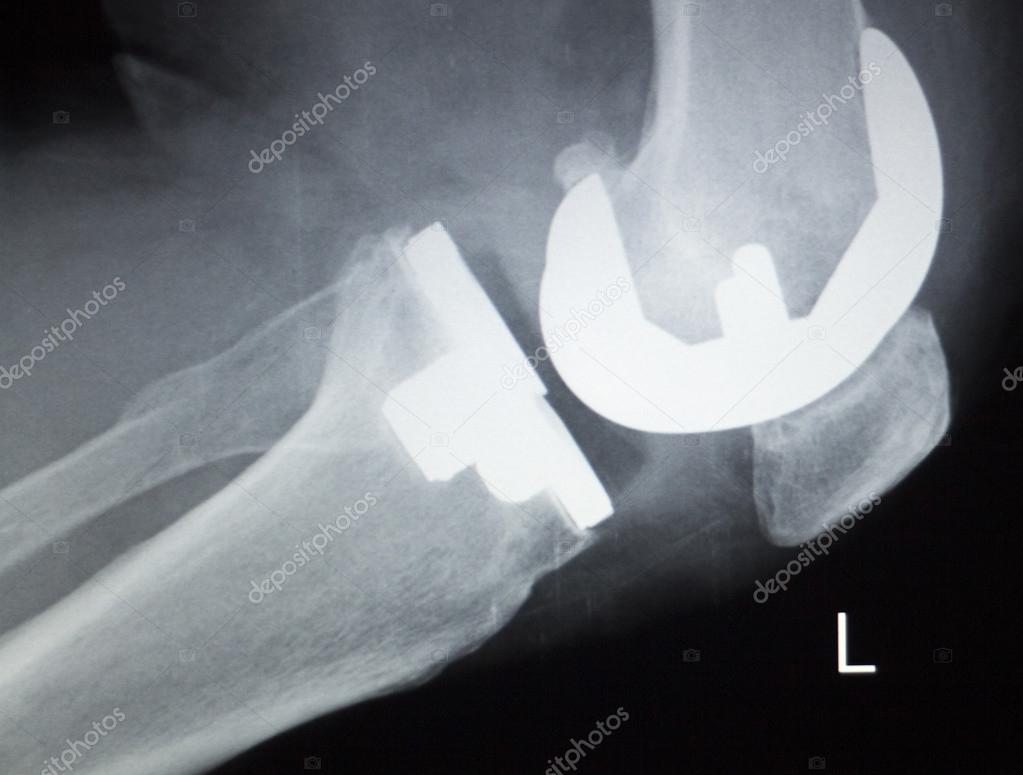 Knee joint orthopedics implant xray Stock Photo by ©edwardolive 118425258