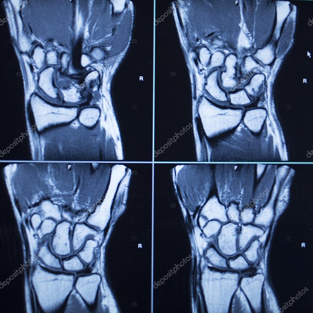 MRI scan test results wrist hand injury Stock Photo by ©edwardolive ...