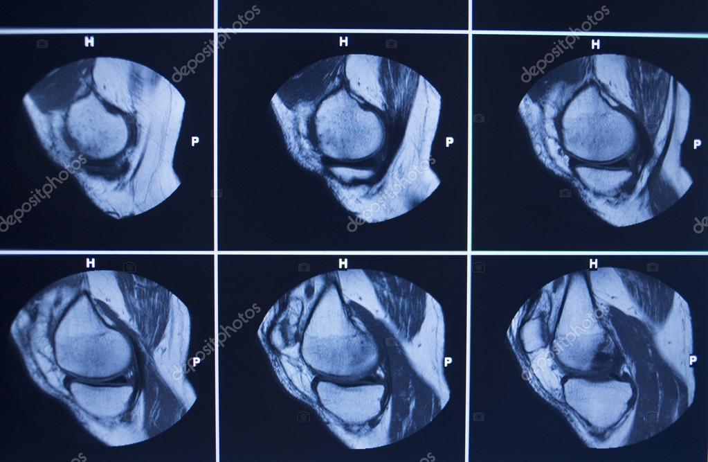 MRI scan hasil tes cedera meniskus lutut — Foto Stok © edwardolive ...