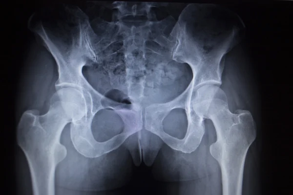RTG miednicy i kręgosłupa kobiety — Zdjęcie stockowe © Lusoimages #13301570