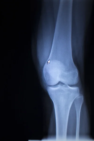 Shin leg ankle injury xray scan — Stock Photo © edwardolive #102330634