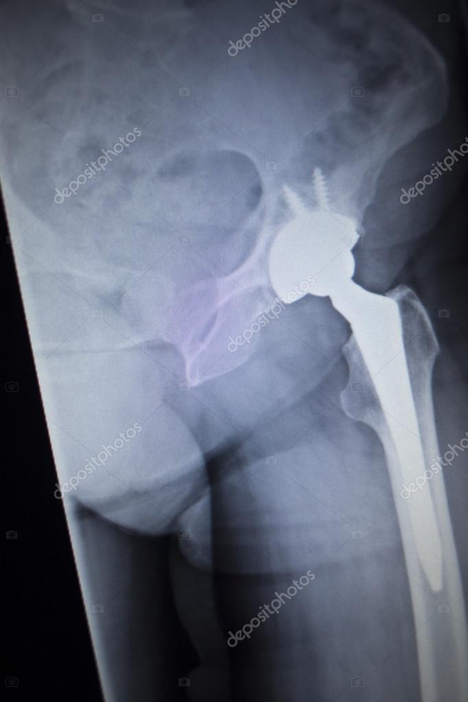 X-ray scan image of hip joint replacement orthopedic implant — Stock ...