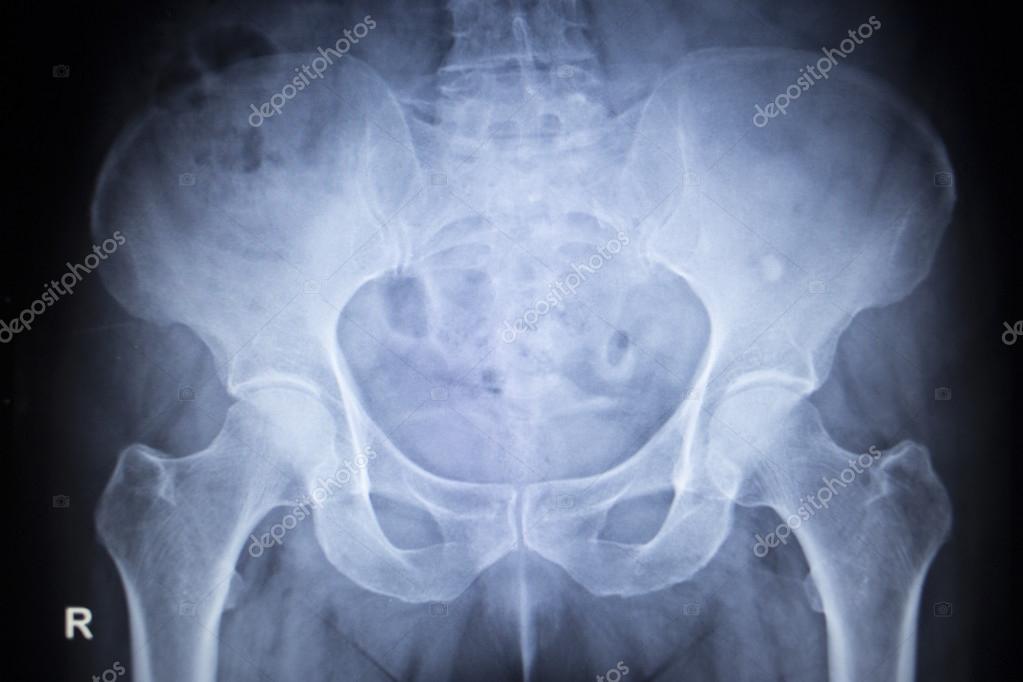 Exploración ortopédica por rayos X de las articulaciones de la cadera ...