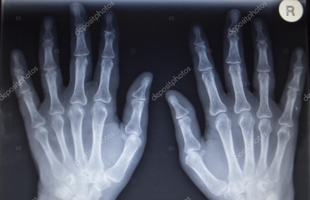 Xray Orthopedic Medical Cat Scan Of Painful Hand Fingers Thumb Stock