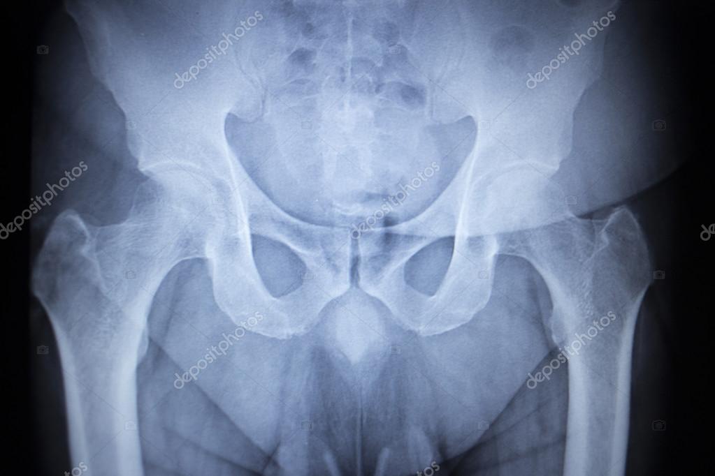 Exploración ortopédica por rayos X de las articulaciones de la cadera ...