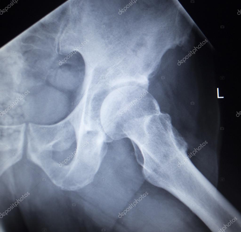 Exploración ortopédica por rayos X de las articulaciones de la cadera ...