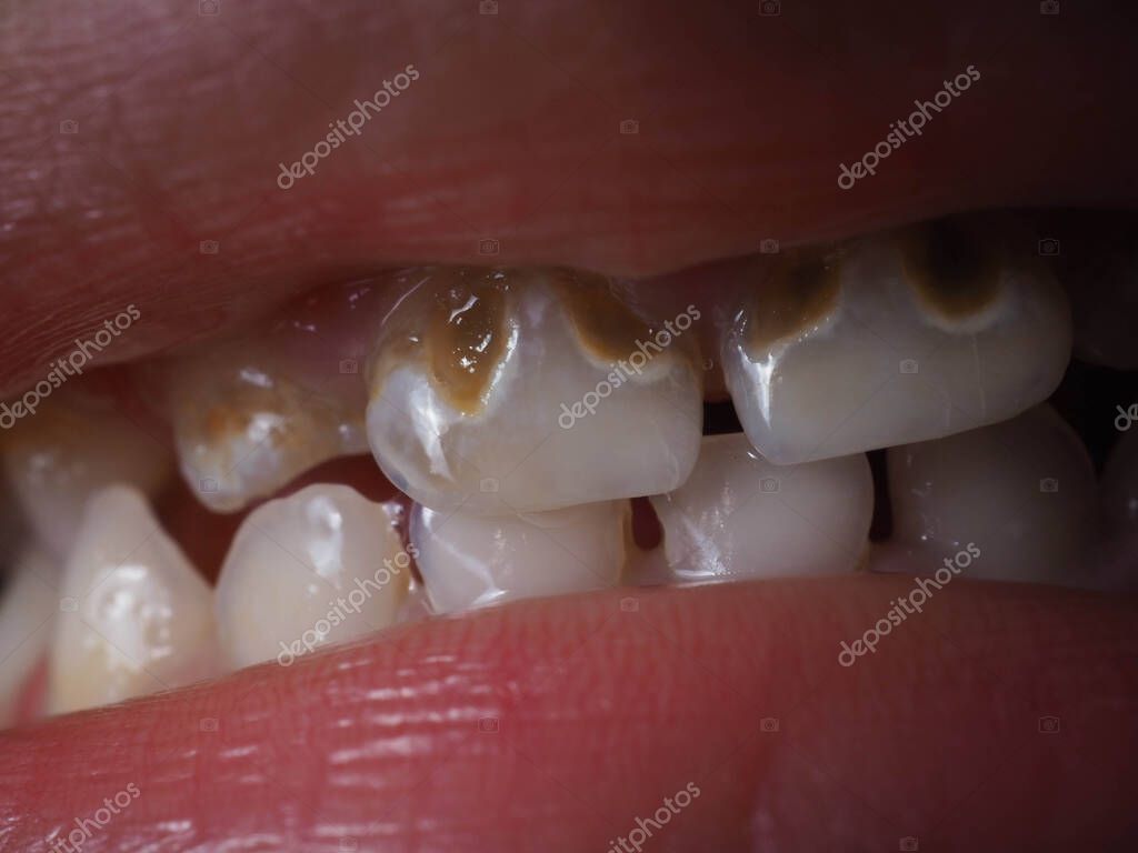 Fotos de los dientes podridos de los niños que generalmente causan una ...