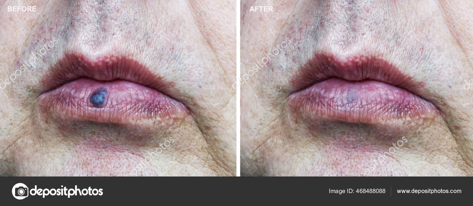 Image Removal Venous Lake Lip Mouth Stock Photo by ©claudiocaridi ...