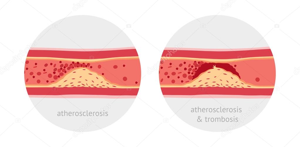 Aterotrombosis en los vasos sanguíneos vector, gráfico vectorial ...