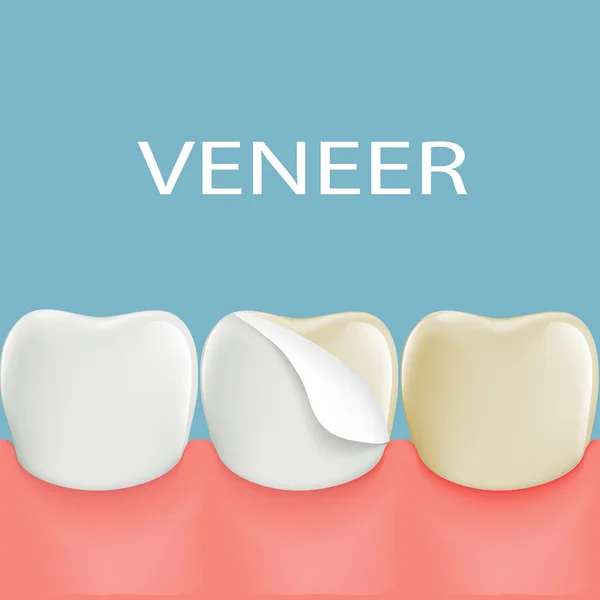 622 Dental veneers Vector Images, Dental veneers Illustrations | Depositphotos