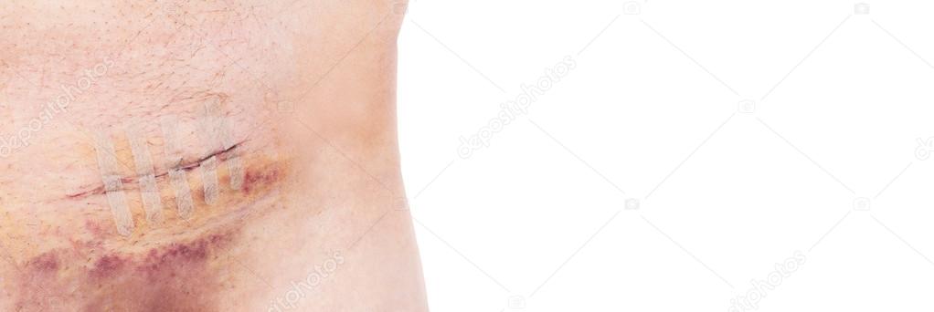 Surgical suture Stock Photos, Royalty Free Surgical suture Images ...