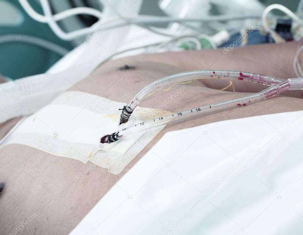 Chest wound drainage of the patient — Stock Photo © sudok1 #103582984