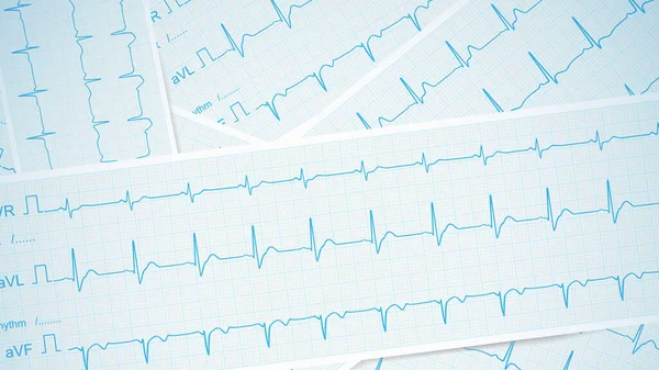 63 Ecg tracing Vector Images, Ecg tracing Illustrations | Depositphotos