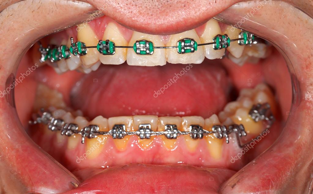 Dental braces — Stock Photo © ocskaymark #66932257