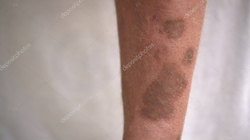 Manchas pigmentadas y úlceras en una pierna de las personas después de ...