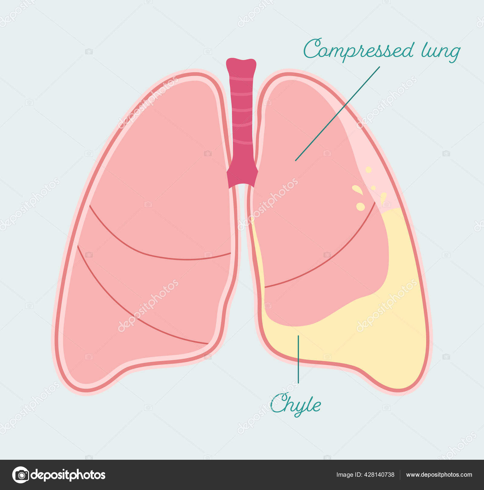 Quilotórax no pulmão humano. Acumulação de linfa no espaço pleural ...