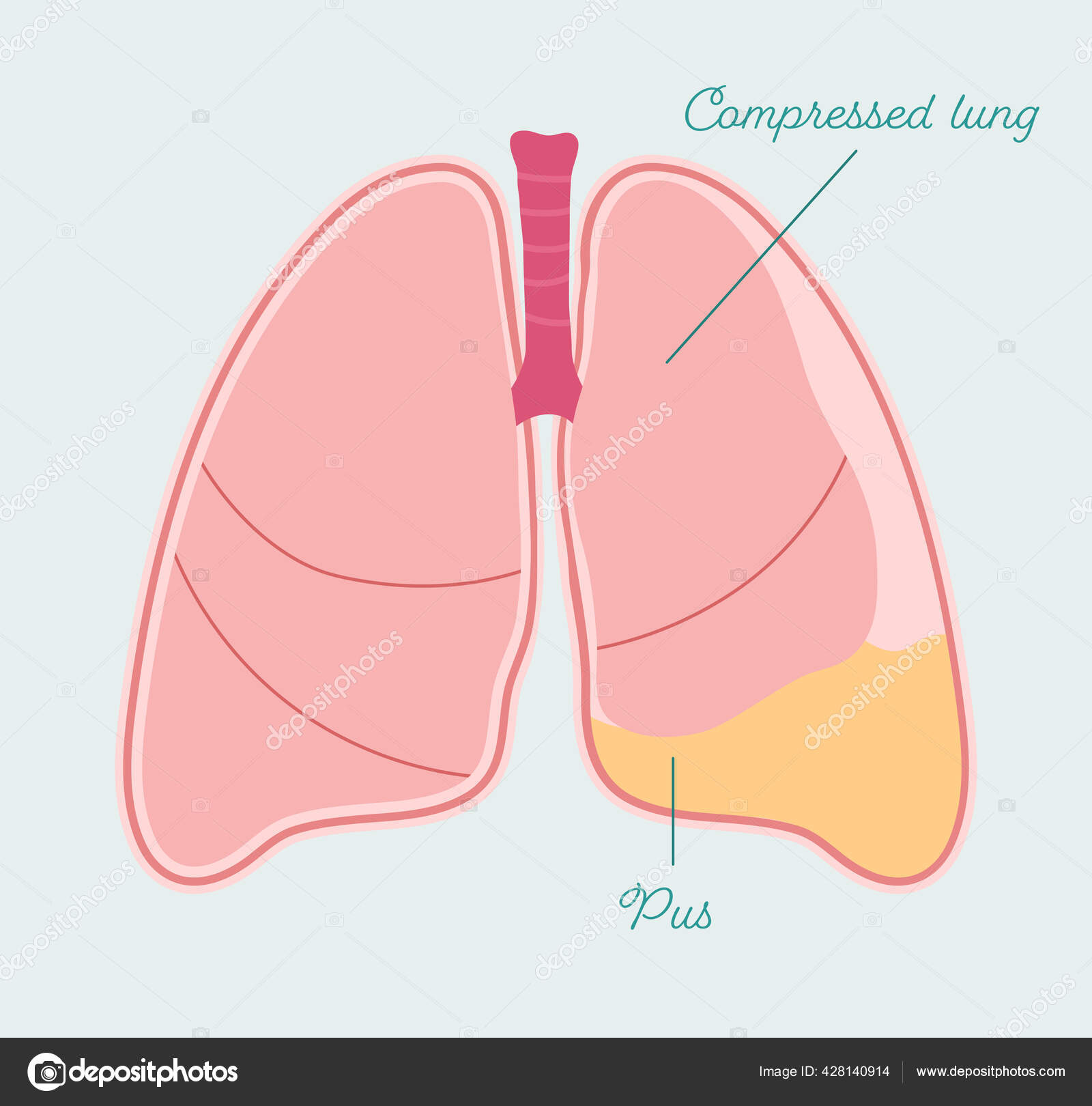 Piotórax no pulmão humano. Empiema pleural, coleta de pus no espaço ...