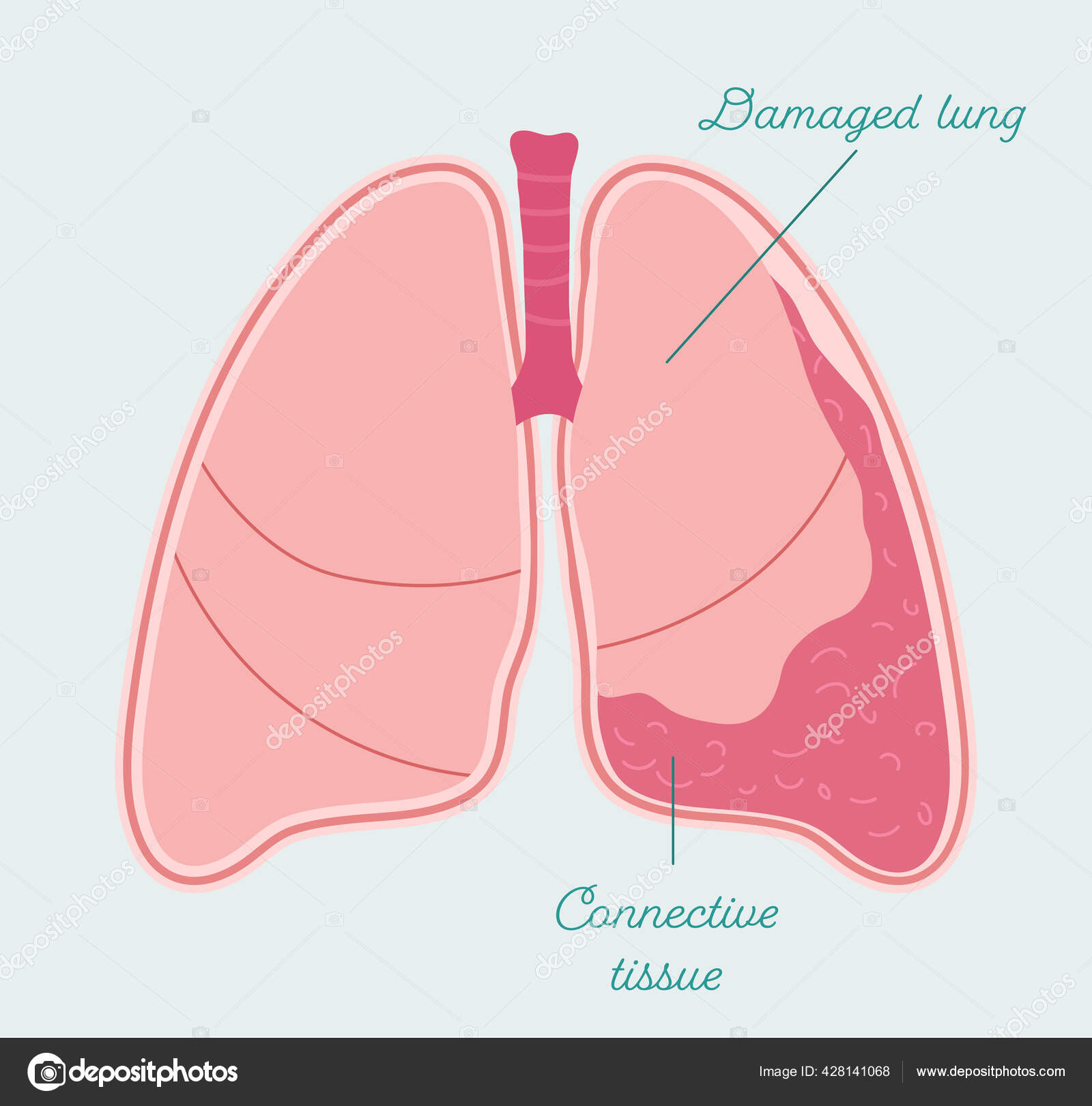 Fibrothorax in human lung. Fibrosis of pleural cavity with compressed ...