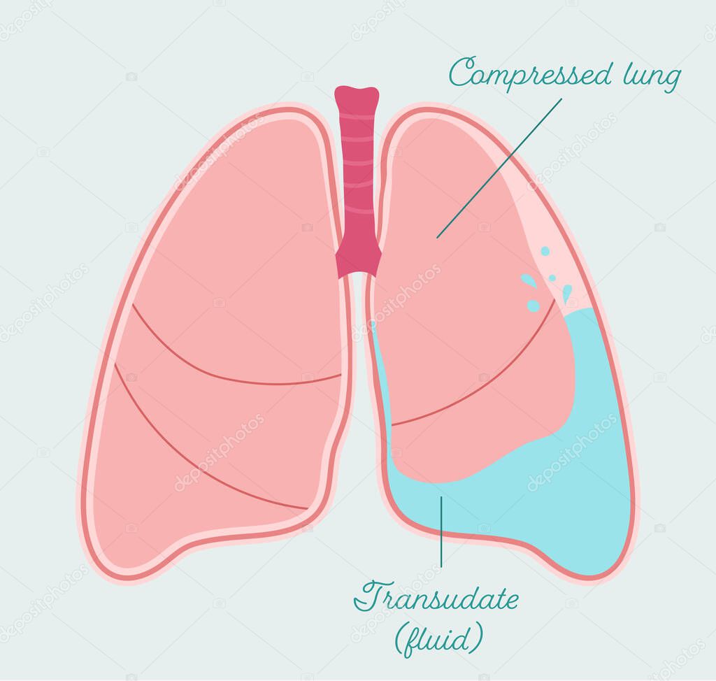 Hydrothorax in human lung. Gathering of fluid in pleural space - vector ...