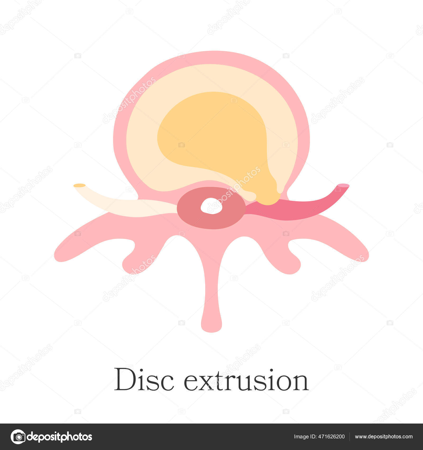 Herniated spinal, stage third, Extrusion and compression nerve Stock ...
