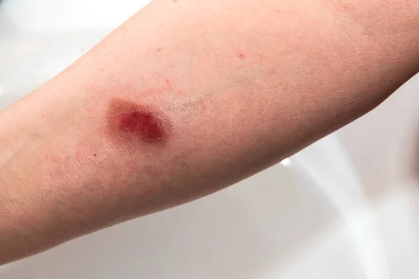 Scald burn Stock Photos, Royalty Free Scald burn Images | Depositphotos