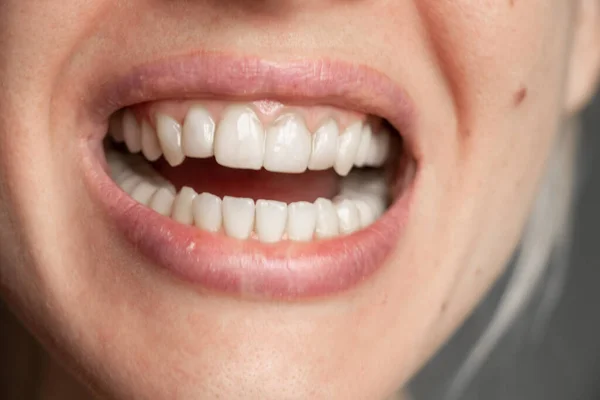 Healthy woman teeth Stock Photo by ©Alexis84 30500113
