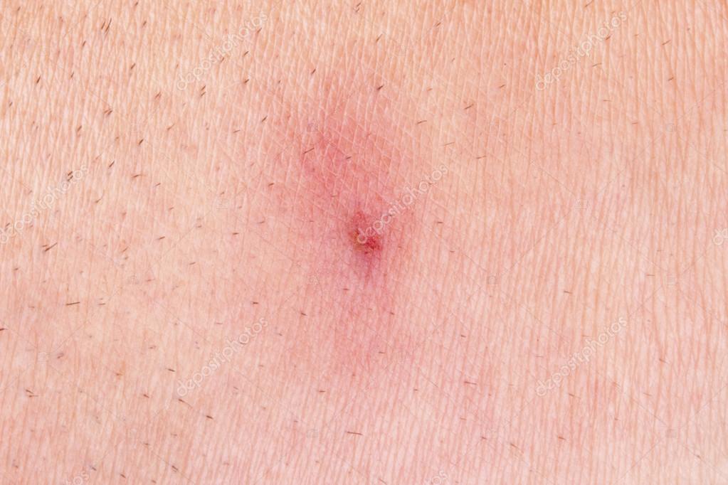 Human skin infection Stock Photo by ©ogichobanov 77127031