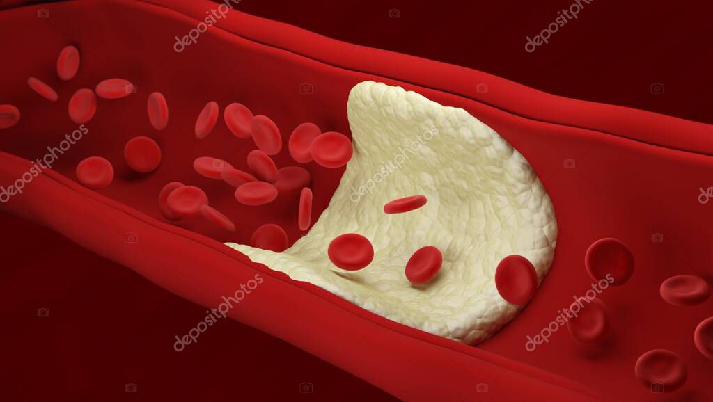 Aterosclerosis. Glóbulos rojos. Arteria. Acumulación de placa. Pérdida de elasticidad de las ...